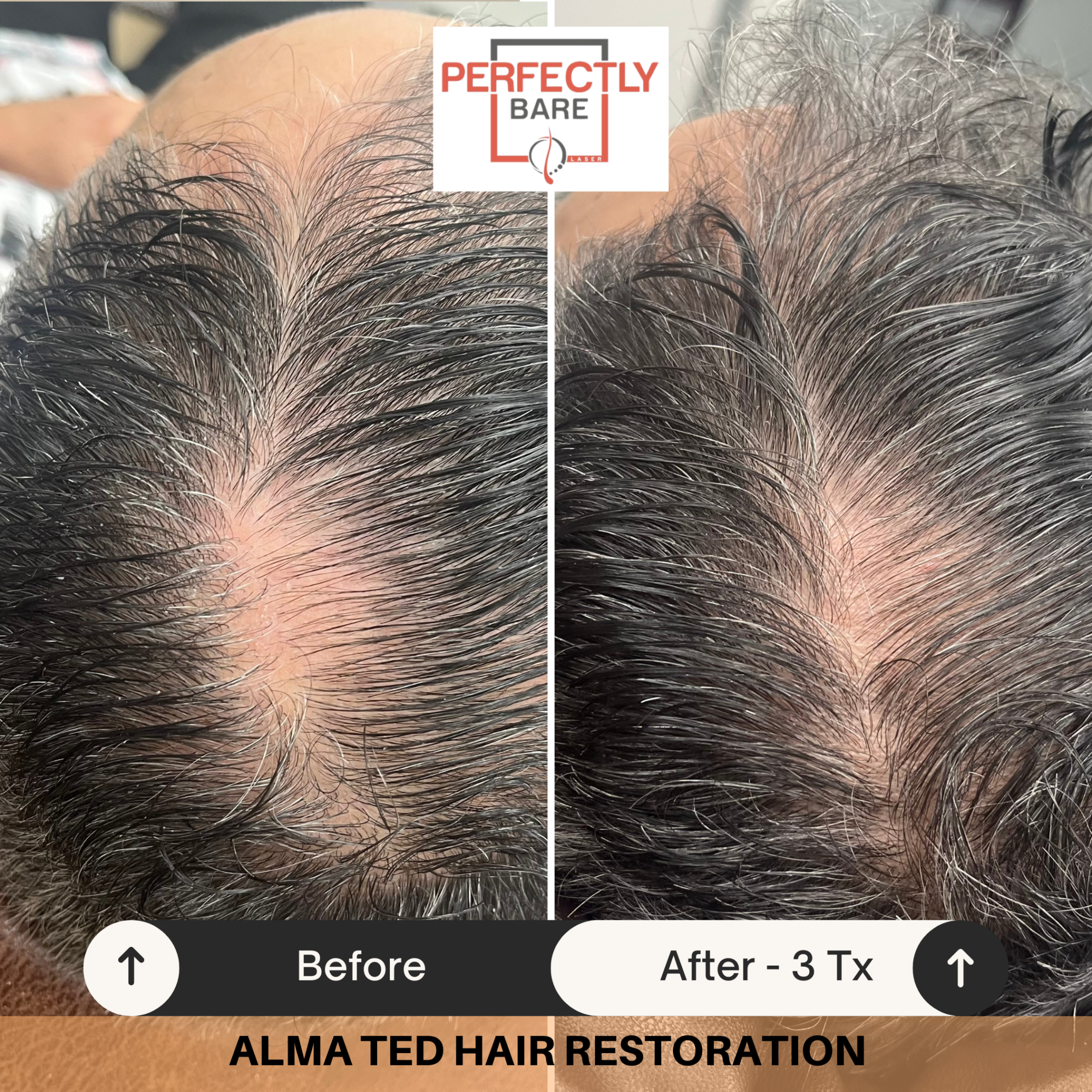TED Hair Restoration Tampa | Pain-Free Hair Loss Treatment